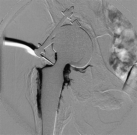 History Of Arthrography Radiologic Clinics