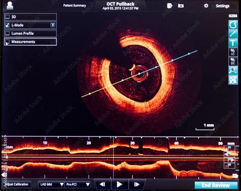 Intravascular Optical Coherence Tomography Oct Image Angiography Catheter Lab Atherosclerosis