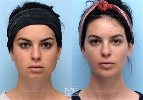 How To Get Defined High Cheekbones With Cheek Filler In San Francisco