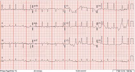 Electrocardiogram On Admission Showed Atrial Fibrillation With Rapid Download Scientific