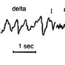 3 EEG recordings from Berger showing α beta β EEG wave A 10 Hz Download Scientific Diagram