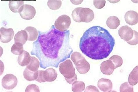 Reactive Lymphocytes Vs Monocytes