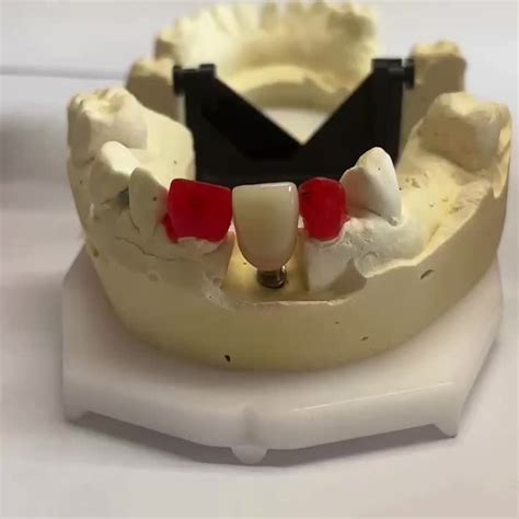 Qcing Interproximal Contacts Adjacent Teeth Are Poured Up In Duralay… Arklign