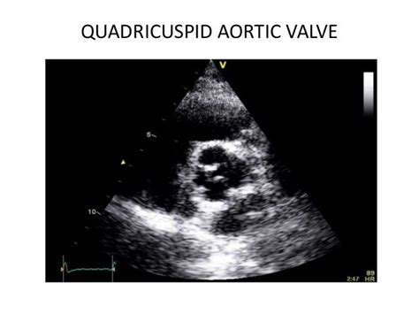 Aortic Stenosis Echo