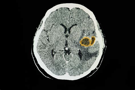 Glioma Pontino Intrínseco Desarrollan Una Nueva Terapia Potencial Para
