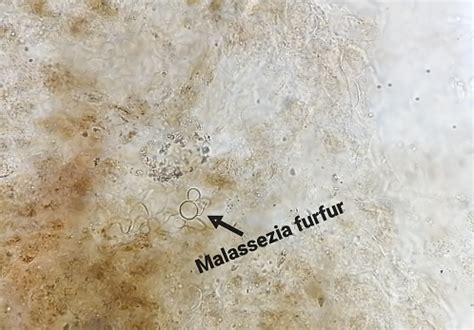 Microscopic View Of Skin Scraping Fungus Showing Fungi Malassezia