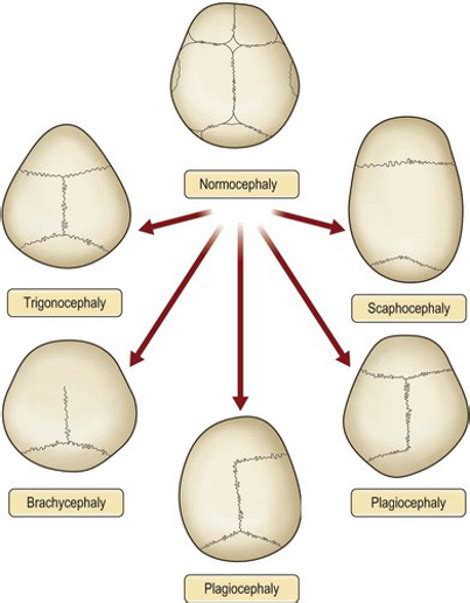 Scaphocephaly