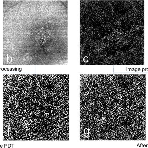 Choriocapillaris Analysis Using The Phansalkar Local Thresholding
