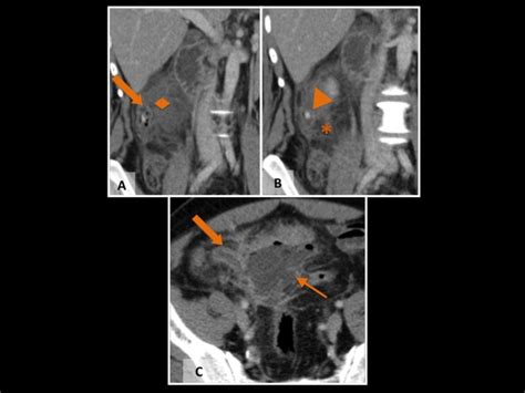 Acute Appendicitis Coronal A And B Ct Scans Show A Fluid Filled Acute Appendicitis Coronal A And B Ct Scans Show A Fluid Filled
