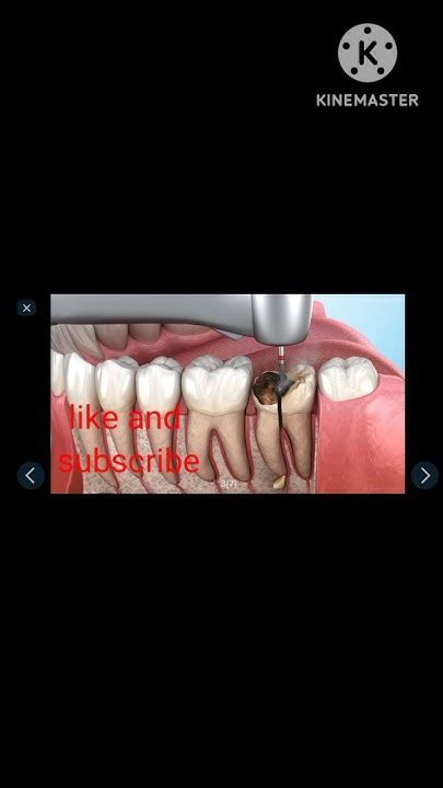 What Is Hemisection Youtube