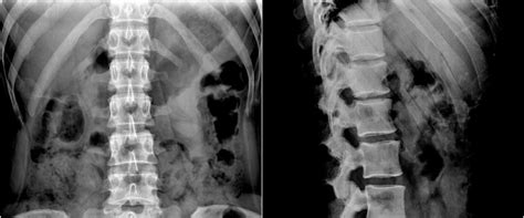 What Is Segmental Spinal Instability Minneapolis Spine Surgeon