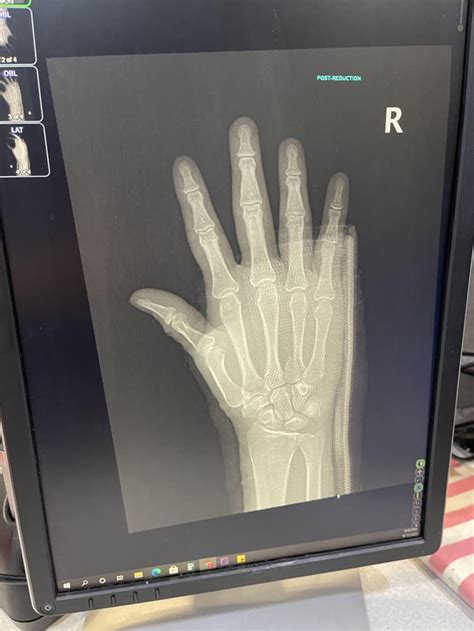 I Broke My 4th Metacarpal And Dislocated My 5th One R Xrayporn