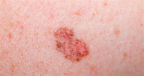 Что такое немеланомный рак кожи обновлено 25 06 2025