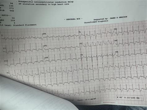 Svt R Ekgs