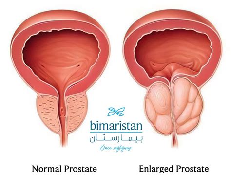Prostatic Artery Embolization In Turkey بيمارستان