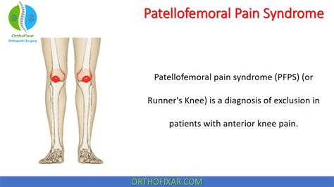 Patellofemoral Pain Syndrome Overview Orthofixar 2025