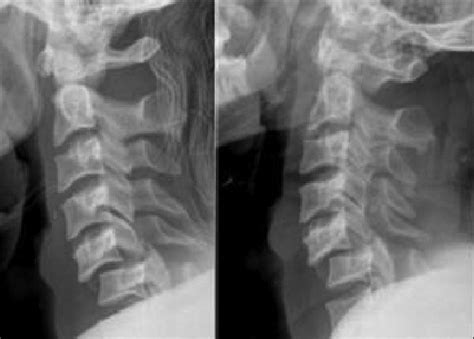 21 Double Vertebrae Sign In Bilateral Facetal Dislocation Lateral
