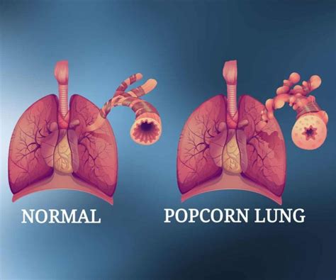 Popcorn Lung Bronchiolitis Obliterans At William Killian Blog
