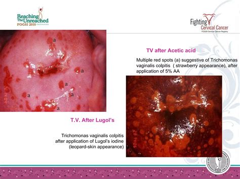 Colposcopy Ppt