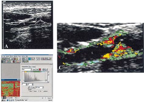Pixel Distribution Analysis Of B Mode Ultrasound Scan Images Predicts