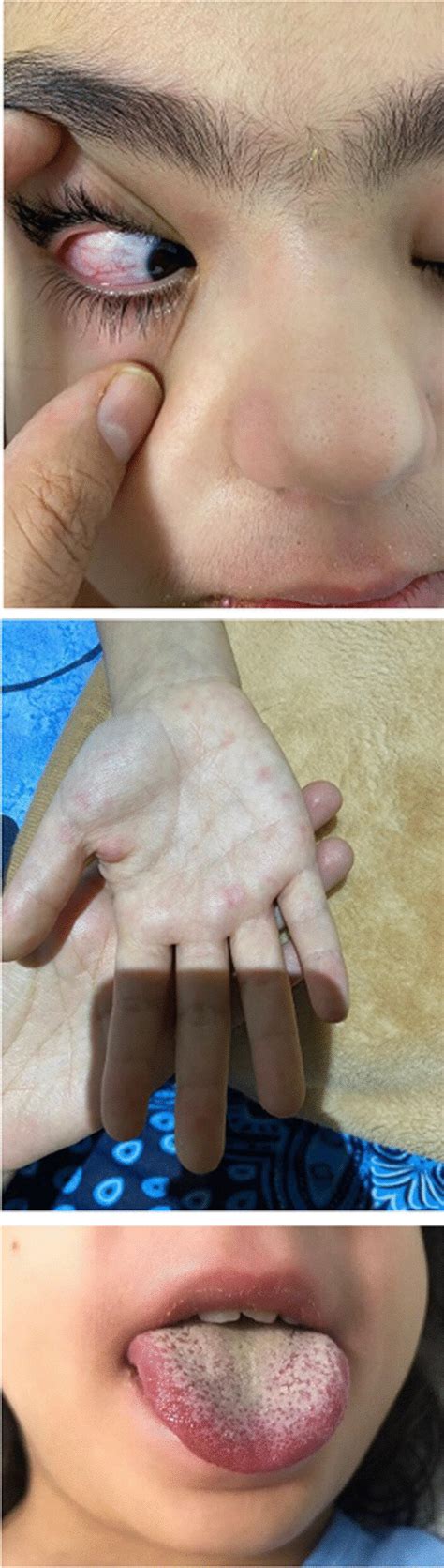Nonpurulent Conjunctivitis Strawberry Tongue Palmar Rash In The Case Download Scientific