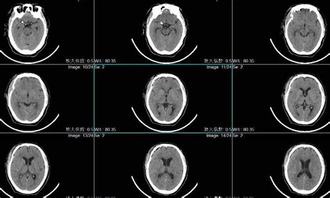 急诊右侧大脑前动脉a1段动脉瘤夹闭术 脑医汇 神外资讯 神介资讯