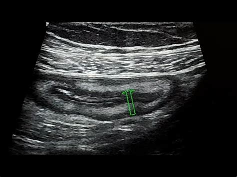 Terminal Ileum Ultrasound