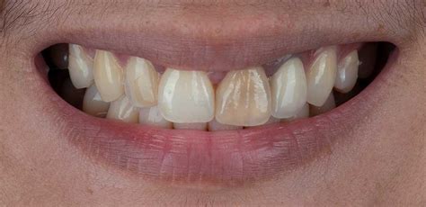 Smile Makeover In Dubai Hollywood Smile Dubai