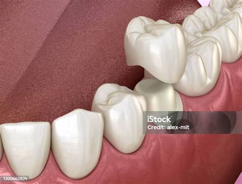 Prearated 전구 치아와 치과 금속 세라믹 크라운 의학적으로 정확한 3d 일러스트레이션 건강관리와 의술에 대한 스톡 사진