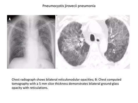 Community Acquired Pneumonia Pptx