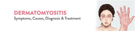 Dermatomyositis Symptoms Causes Diagnosis And Treatment Ck Birla