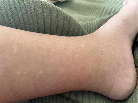 White Spots Album On Imgur