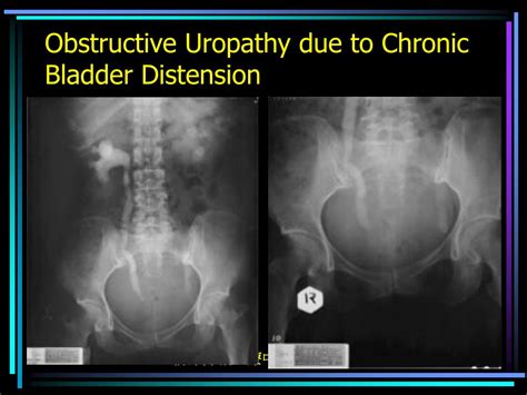 Ppt Bladder Outlet Obstruction In Women Powerpoint Presentation Free Download Id 5671356