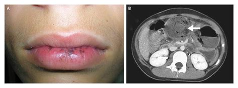 Peutz Jeghers 千图网