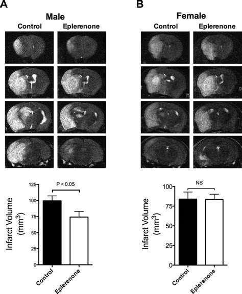 Myeloid Mineralocorticoid Receptor During Experimental Ischemic Stroke Effects Of Model And Sex