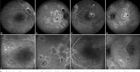 Figure 2 From Subretinal Fluid In A Patient With Systemic Lupus