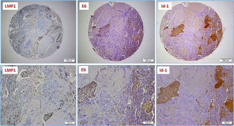 A Case Of Poorly Differentiated High Grade Non Keratinizing Cervical Download Scientific