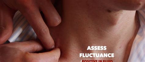 Neck Lump Examination Osce Guide Geeky Medics