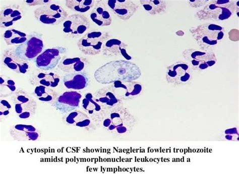 Cerebrospinal Fluid Csf Examination Under Microscope