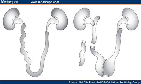 Ureterectomy