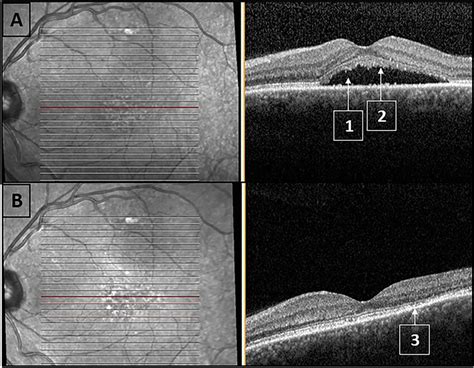 A Oct Of A Patient With 3 Months Duration Cscr Before Pdt Early Download Scientific Diagram