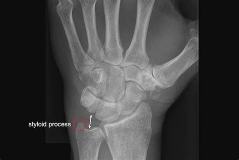 Commonly Missed Or Mismanaged Wrist Injuries Emergency Medicine Cases