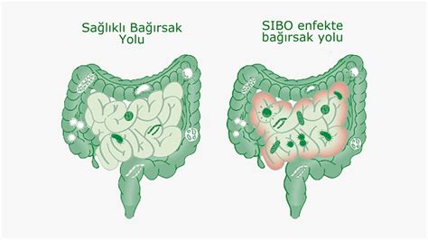 Sibo Uzm Dr Nuray Evrin Fonksiyonel Tıp