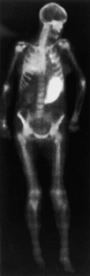 Bone Scintigraphy Of A Patient With Metastatic Calcification Due To Crf Download Scientific
