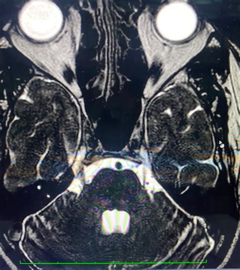 Dr Sonam Sanjay บน Linkedin A Case Of Trigeminal Neuralgia On Left Side The Left Superior
