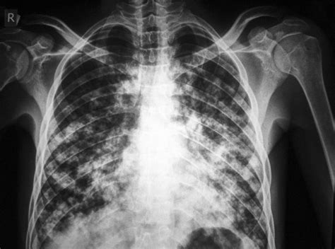 Chest X Ray Showing Multiple Bilateral Lungs Patches With The