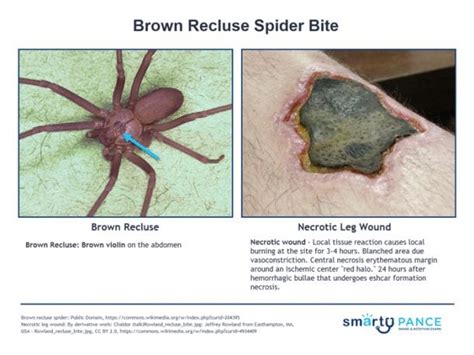 Pance Blueprint Showdown Black Widow Vs Brown Recluse Spider Bites