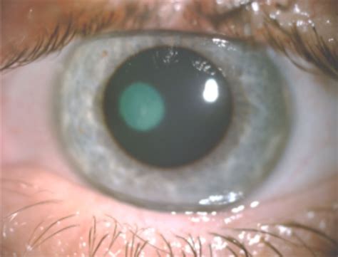 Viral Corneal Ulcer Eye Injuries — Real First Aid
