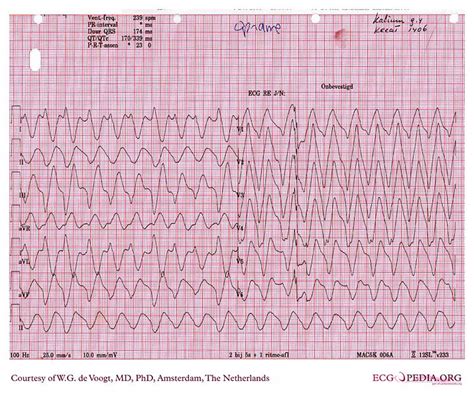Sine Wave Hyperkalemia Ecg Changes