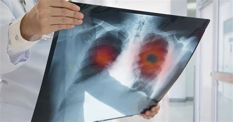 El Cáncer De Pulmón El Más Mortal Mata A Más Personas Que Los De Mama